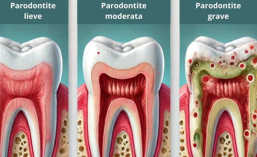 Parodontite e Piorrea: Sintomi, Cause e Trattamenti Efficaci