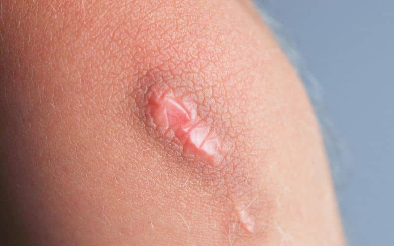 Come curare le piaghe da decubito